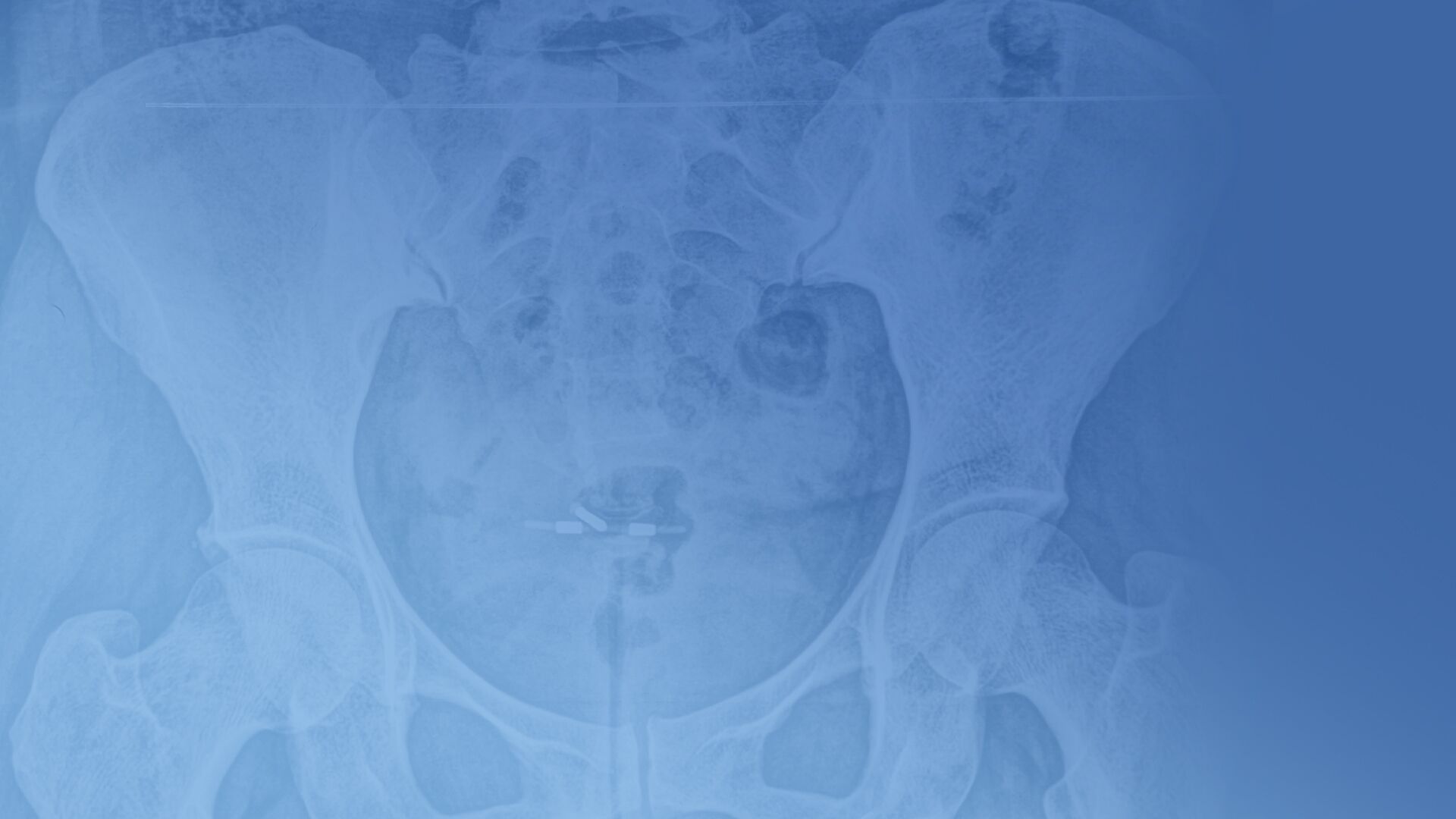 Orlando Foreign Objects Left in Body Lawyers | Orlando Foreign Objects Left in Body Attorneys ...